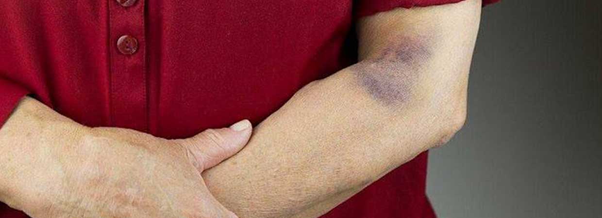 Comment faire pour avoir un bleu