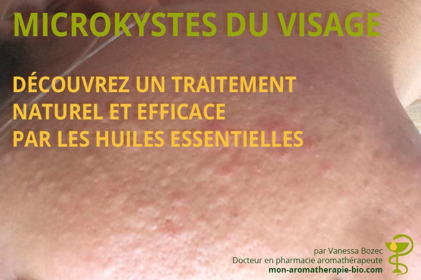 Comment reconnaître un Microkyste
